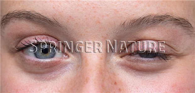 Myasthenia gravis: eine neuromuskuläre Übertragungsstörung