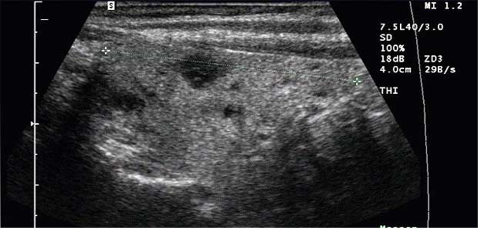 L-Thyroxin plus Jodid: Beste Medikation bei Knotenkropf