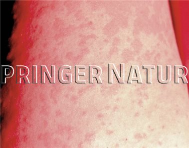 Juckende Quaddeln durch Wurmbefall