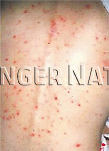 Wenn Varizellen zuschlagen: Windpocken und Gürtelrose