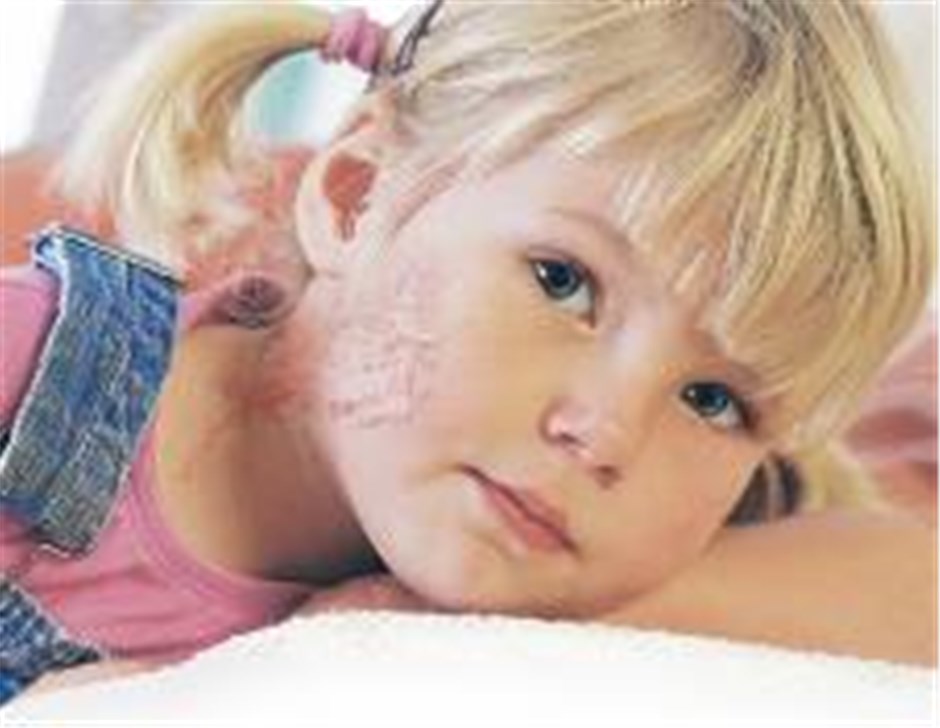 Tipps gegen Verbrennungen bei Kindern