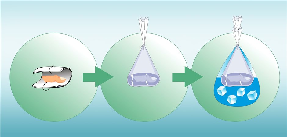 So werden Amputate richtig aufbewahrt