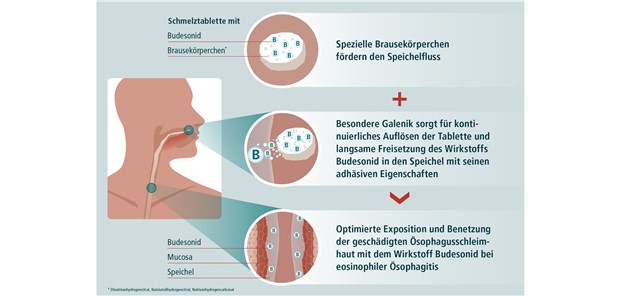 Jorveza® – erste zugelassene Therapie bei eosinophiler Ösophagitis