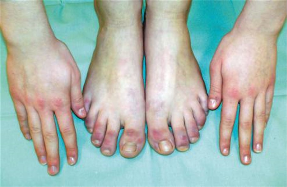 Akrozyanose verläuft bei jungen Frauen meist gutartig