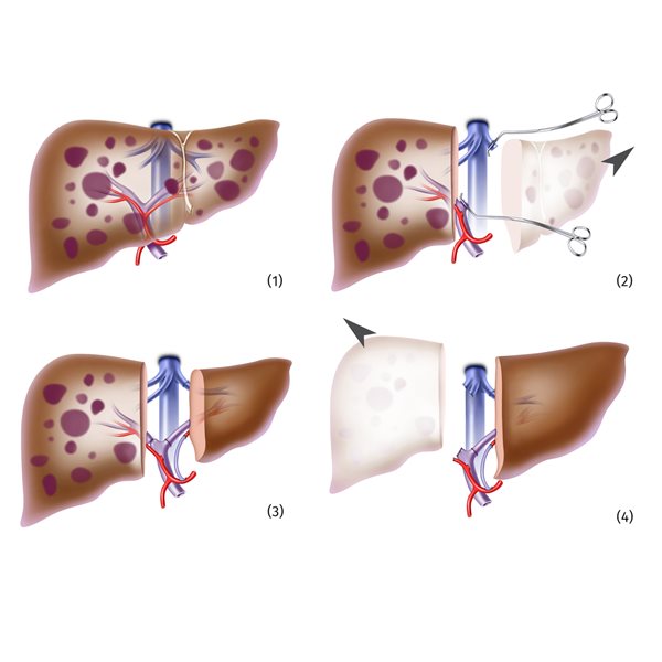 Behandlungsoption bei Lebermetastasen: zweistufige Transplantation
